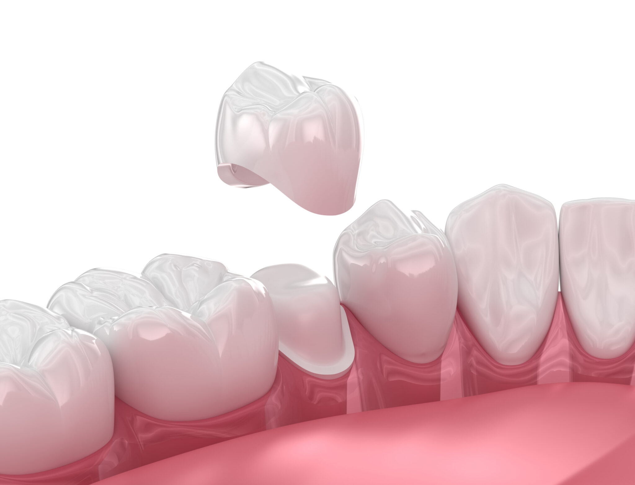 How Long Does It Take To Put A Crown On The Tooth?